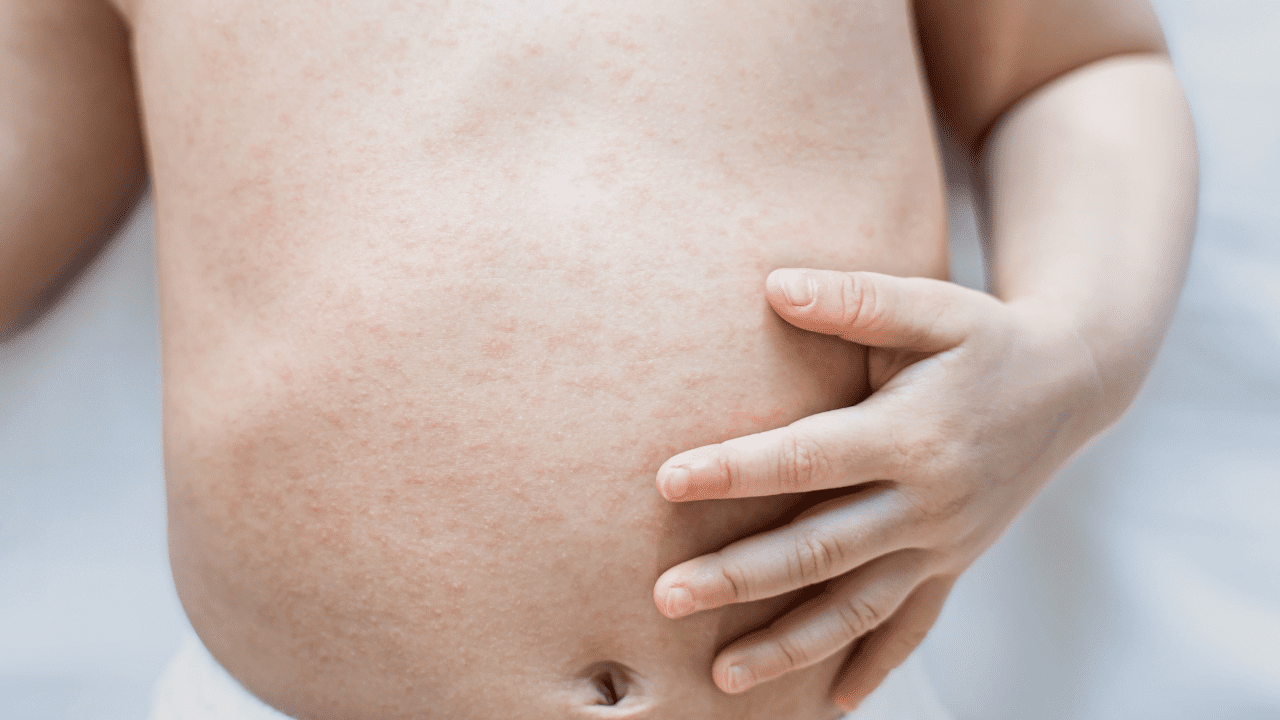 Brotoeja em bebês: por que ocorre e como tratar?